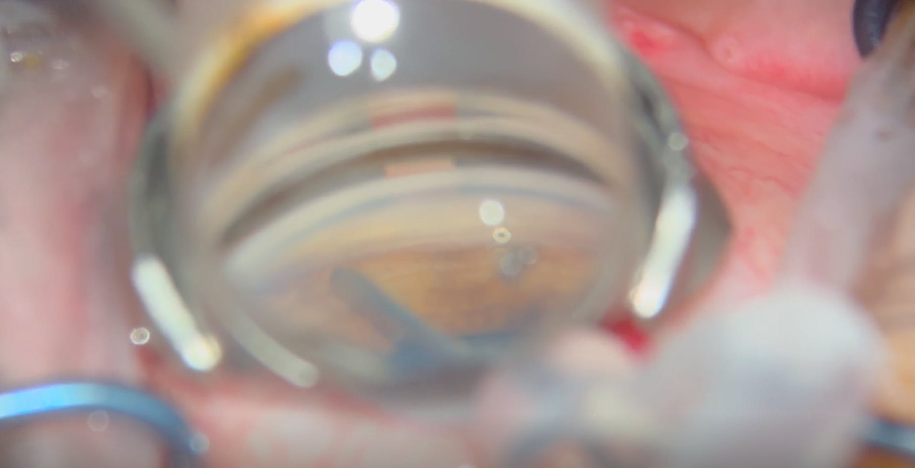 iStent Infinite in Case of Mild Glaucoma - Eyetube